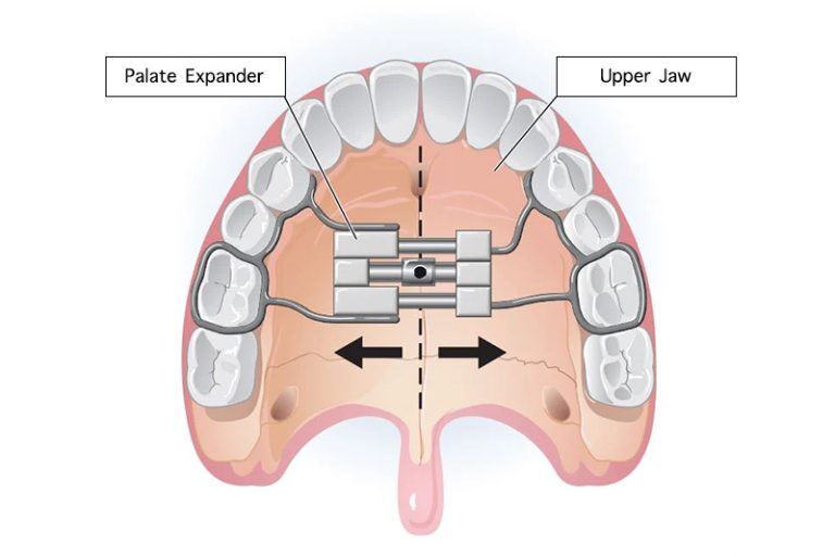 Palatal Expansion Make | Types | Cost | Pros & Cons | Who Needs